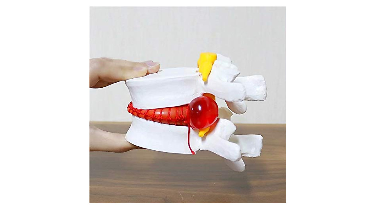 Global-Dental Herniated Disc Model - Lumbar Anatomy Aid