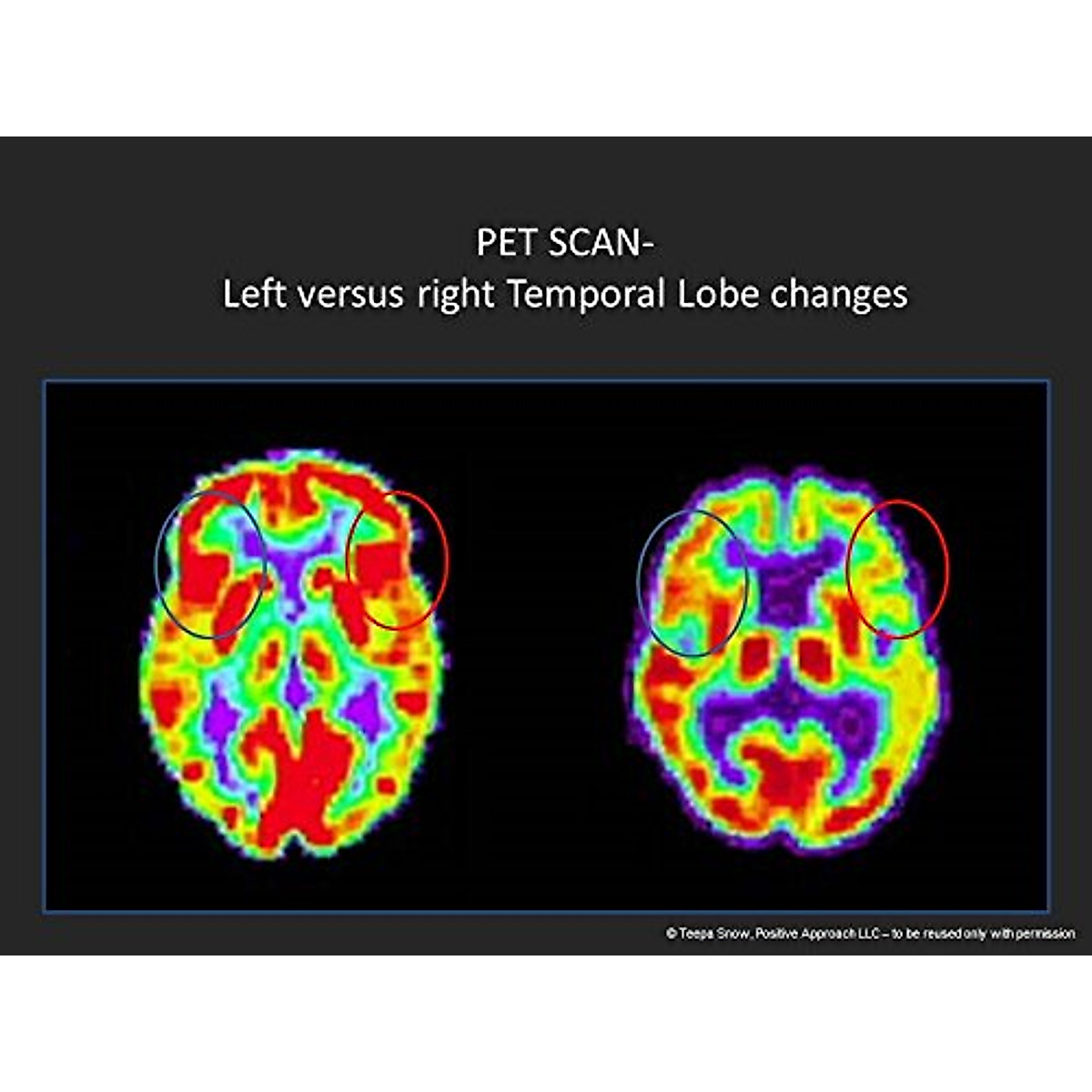 "Understanding Frontotemporal Dementias (FTDs)" 2-DVD Set with Dementia Trainer Teepa Snow