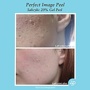 Salicylic Gel Chemical Peel - Enhanced with Green Tea Extract and Tea Tree Oil (20% Strength)