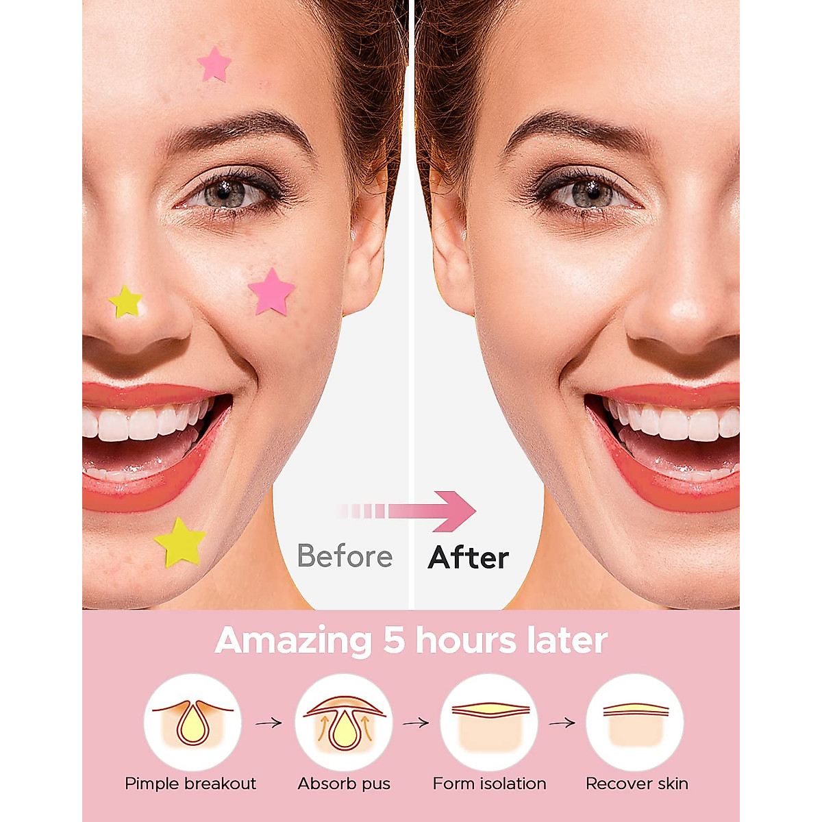 LitBear Acne Patch Pimple Patch, Pink & Yellow Star Shaped Acne Absorbing Cover Patch, Hydrocolloid Acne Patches For Face Zit Patch Acne Dots, Tea Tree Oil & Centella, 112 Patches, 14mm & 10mm