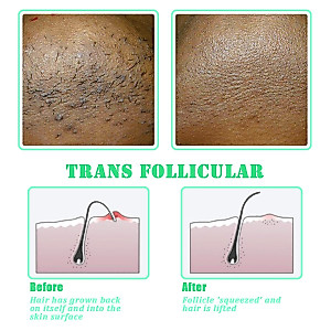 TailaiMei Exfoliating Brush for Ingrown Hair Treatment - To Treat and Prevent Bikini Bumps, Razor Bumps - Silky Smooth Skin Solution for Men and Women