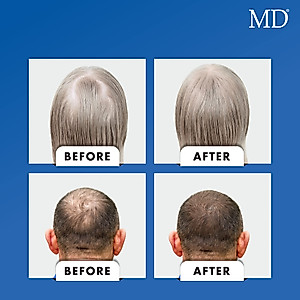 MD Nutri Hair Growth Supplement con biotina (30 cápsulas) | Previene la caída del cabello, minimiza la caída del cabello, el adelgazamiento, la rotura y promueve el cabello más largo y grueso | Formul