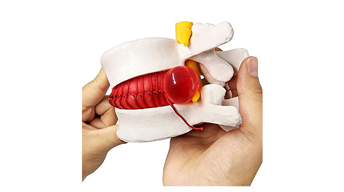 Realistic Herniated Disc Model for Medical Education