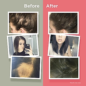 Naturenetics HairAnew Hair Growth Vitamins for Women & Men - Hair Vitamins For Faster Hair Growth & Thickness - Part of Proceeds go to Hair Loss Charity - Vegan Hair Supplement For Hair Skin Nails (1)