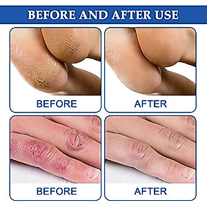 LONGLUAN Chilblain Cream, Anti-cracking Frostbite Moisturiser, Anti Crack Cream for Hands and Foot, Cracked Skin Repair Cream, Chapped Repair Cream, Deep Nourishing 30g (1)