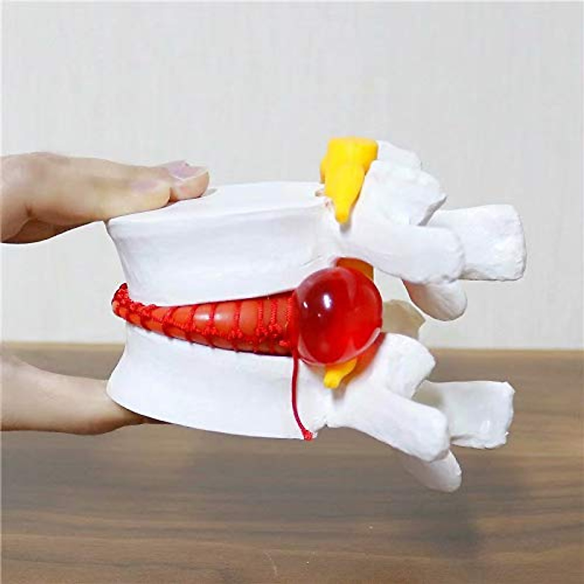Global-Dental Anatomical Herniated Lumbar Vertebrae Disc Prolapse Model Human Anatomy Model White