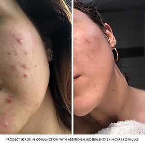 Bioelements Moisture Positive Cleanser - Rich Facial Cleanser for Dry Skin - Vegan, Gluten Free - Never Tested on Animals, 6 Fl Oz (Pack of 1)