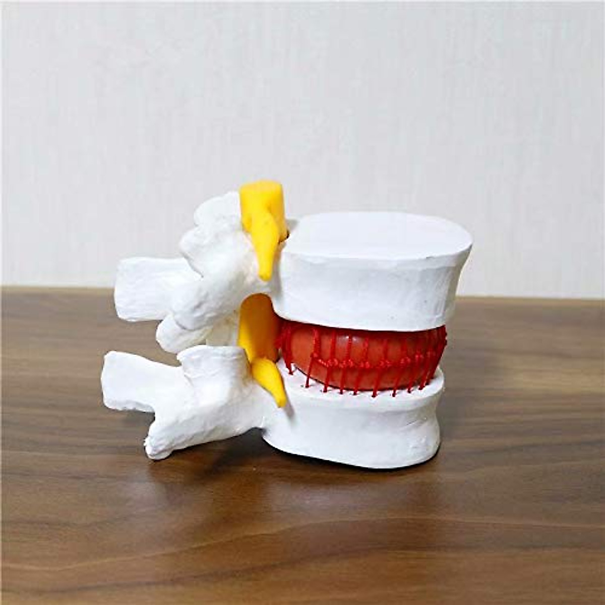Global-Dental Anatomical Herniated Lumbar Vertebrae Disc Prolapse Model Human Anatomy Model White