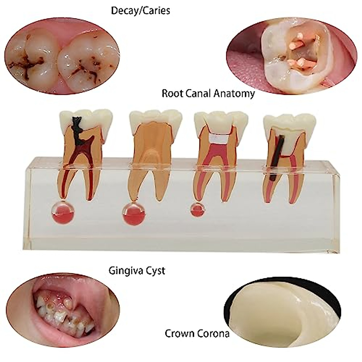 Dentalmall Dental 4-Stage Endodontic Treatment Model for Study Teach Teeth Model 4018 Root Canal Anatomy Demonstration Teaching Tooth Model