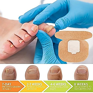 Toenail Fungus Treatment Extra Strength - Nail Fungus Treatment For Toenail, Toe Nail Fungus Treatment Extra Strength, Nighttime Fungal Nail Patches &amp; Fungus Nail Treatment Liquid Set (21patches+15ml)