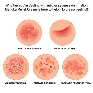 UEUEKOKO Eczema Psoriasis Manuka Relief Honey Cream, Hand Foot, Tinea Versicolor, Itchy Feet, Butt, Anal Itch, Scalp Dandruff, Bee Sting, Bites, Boil Cyst, Armpit, Adults Kids, Hidradenitis Treat