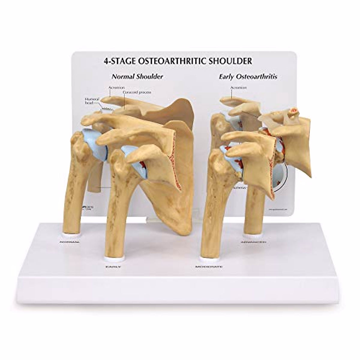 GPI Anatomicals Shoulder Joint Model Set | Human Body Anatomy Replica Set of 4-Stage Osteoarthritis Shoulder Joint for Doctors Office Educational Tool