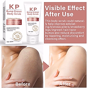 Exfoliating Body Scrub, Keratosis Pilaris Treatment, Body Scrub Exfoliator