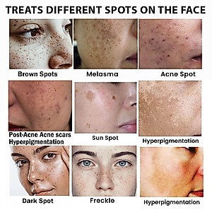 Dark Spot Remover For Face Serum With Vitamin C and E, Retinol, Salicylic Acid, Kojic Acid, Niacinamide, Azelaic acid, Lactic Acid, 4-Butylresorcinol, Licorice. Hyperpigmentation Treatment, Acne Scar Spot Treatment Fade Post-Acne Hyperpigmentation. Brown