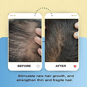 Mediceuticals Bioclenz Shampoo - Anti-Shedding Shampoo for Women and Men - Shampoo for Hair Loss Due to Telogen Effluvium - Postpartum Hair loss Shampoo - For Normal Hair and Scalp 33.8 oz (1L)