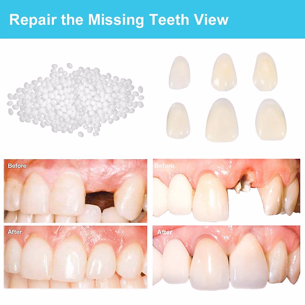 Brige Tooth Repair kit for Filling The Missing Broken Tooth and Gaps-Moldable Fake Teeth and Thermal Beads Replacement Kit