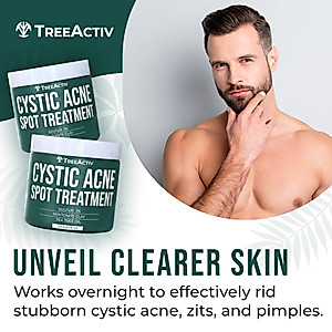 TreeActiv Cystic Acne Spot Treatment, 2-Pack, Sulfur Spot Treatment, Hormonal Acne Treatment with Tea Tree, Cystic Acne, Blackheads, Cystic Acne Treatment and Pimple Spot Treatment for Face, 240+ Uses