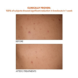 Dr Dennis Gross Alpha Beta Exfoliating Body Treatment | Multi-Tasking Powered by AHA/BHAs for Smooth, Hydrated Skin While Improving Ingrown Hairs, Keratosis Pilaris, and Blemishes | 8 Textured Towels