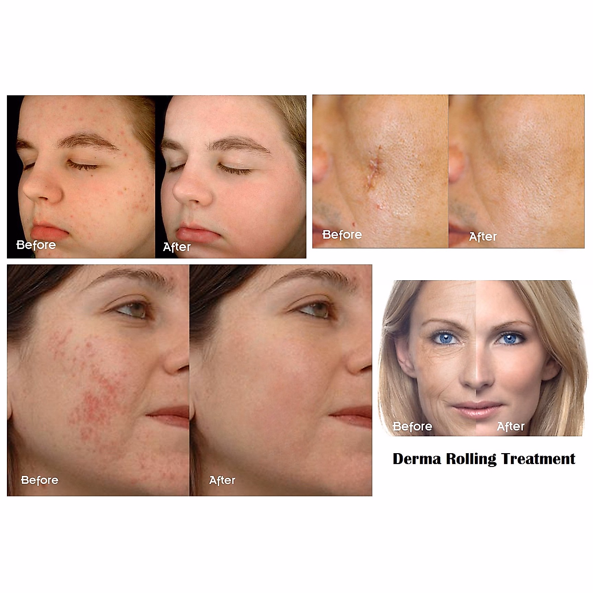 Copper Peptide Serum With Swiss Apple Stem Cell Boosts Collagen Production. Ideal Result Working with Derma Roller.