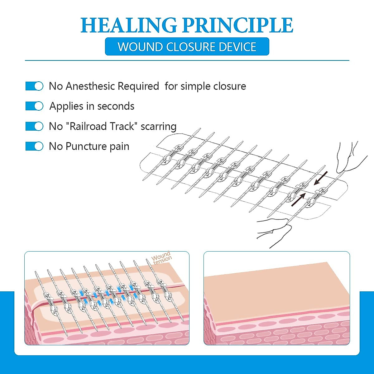Large Butterfly Bandaids, Steri Strips Wound Closure, Emergency Wound Closure Device Surgical Laceration Repair without Stitches for Extra Large Wound Care, Ahead Be Prepared (PU)