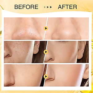 Turmeric Clay Stick Mask Organic Vitamin C Purifying Mask for Blackhead Cleansing Healing Clay Mud Mask for Deep Clean Pore Improve Skin Acne Scars Facial Mask With Blackhead Remover Extractor Tools