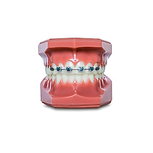 Snapcaps Braces Bumper Cover, Orthodontic Bracket Wax Substitute, Alternative Snap-on Braces Guard Braces Accessories 10 pack (Butterfly)