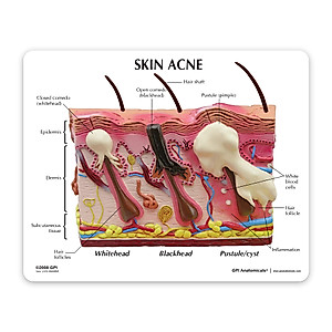 Skin Acne Cross-Section Model | Human Body Anatomy Replica of Common Skin Acne for Dermatology Educational Tool | GPI Anatomicals