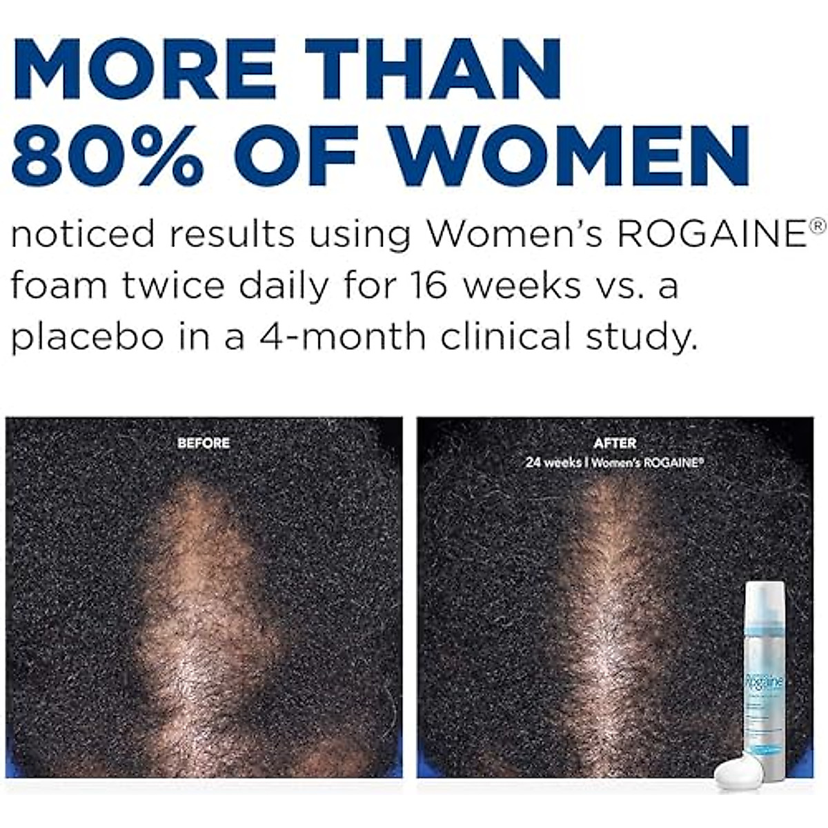 Rogaine 5% Minoxidil Foam, Topical Once-A-Day Hair Loss Treatment for Women to Regrow Fuller, Thicker Hair, Unscented, 2-Month Supply, 2.11 oz