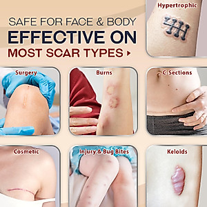 Ebanel Advanced Silicone Scar Gel with Allantoin, Emu Oil, Vitamin E and Onion Extract, Medical-Grade Cream for Old & New Scars from Surgeries, C-Section, Injuries, Burns, Keloids & More