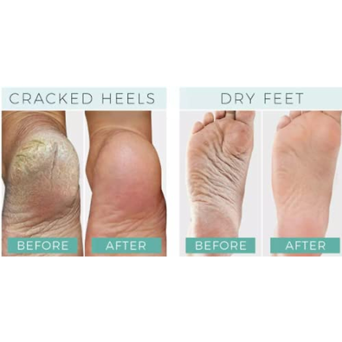 Peach Foot Peel Mask - Repair Cracked Heels, Remove Dead Skin. Makes Your Feet soft And Beautiful