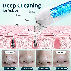 Blackhead Remover Wurkkos Pore Vacuum with Camera Black Head Remove Tools Acne Comedone Pimple Extractor with 6 Suction Heads for Phone,Tablet PC,Computer Facial Suctioner for Women & Men(Pink)