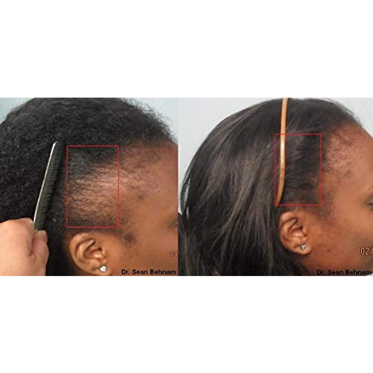 Infinix Scalp & Hair Treatment Pack-Black Seed Oil-Thick and Full & Biotin Infused-Finishing, Repair and Soothing - For irritated, Itchy Scalp - For Hair growth - Pack of 2