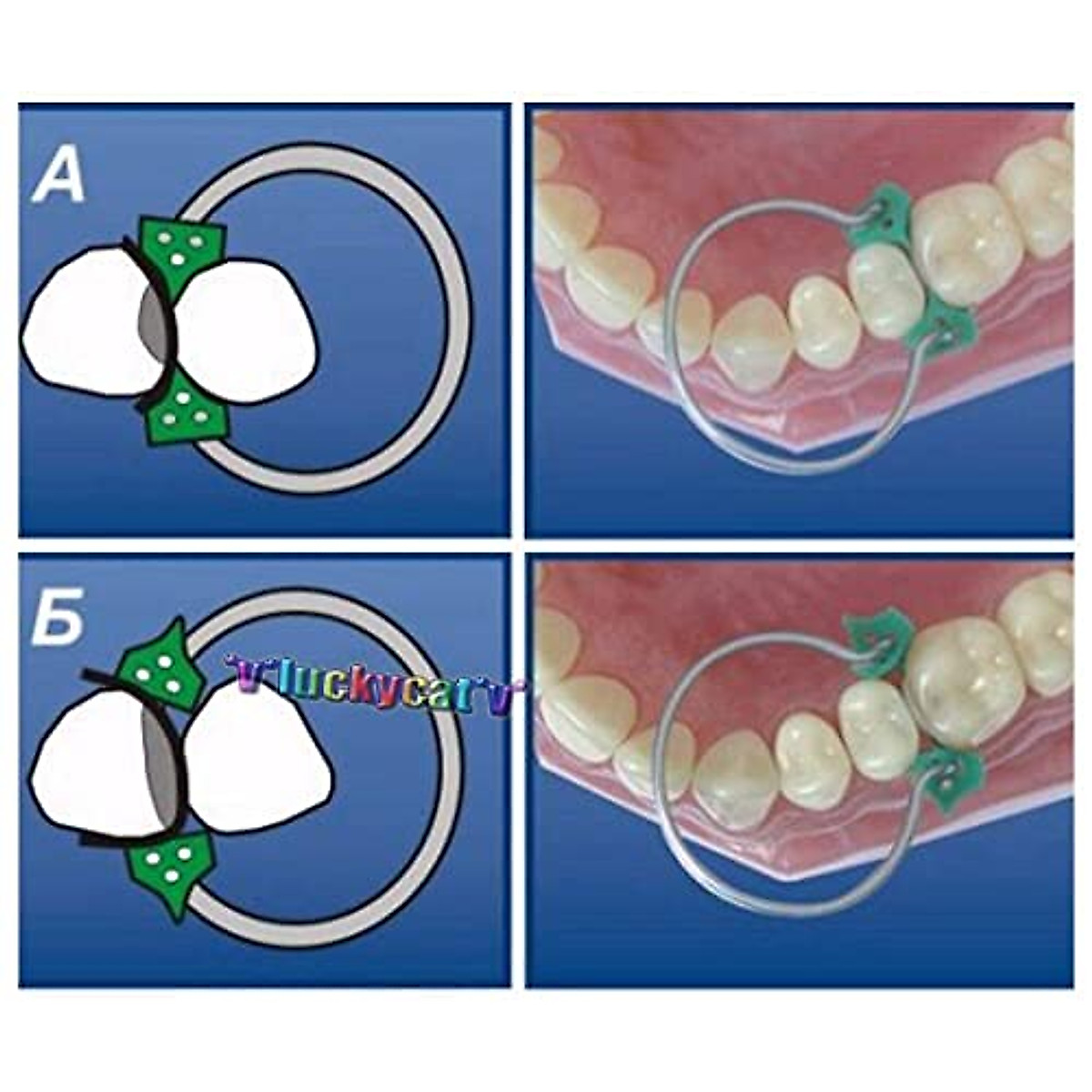 Tazrigo 100Pcs/Set Dental Sectional Contoured Matrices Matrix Ring Delta with 40Pcs Add-On Wedge