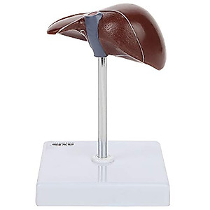 Axis Scientific Anatomy Model of Diseased Liver | Model is 1/3 Life-Size and Divides in 2 Parts | Shows 6 Liver Diseases and Abnormalities | Comes on a White Base