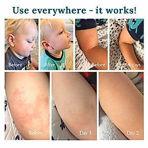 Baby and Kids Moisturizing Cream for Sensitive Skin Multi Purpose for Eczema Psoriasis Rosacea Dermatitis Rash, Healing Therapy for Dry Cracked Irritated Itchy Skin