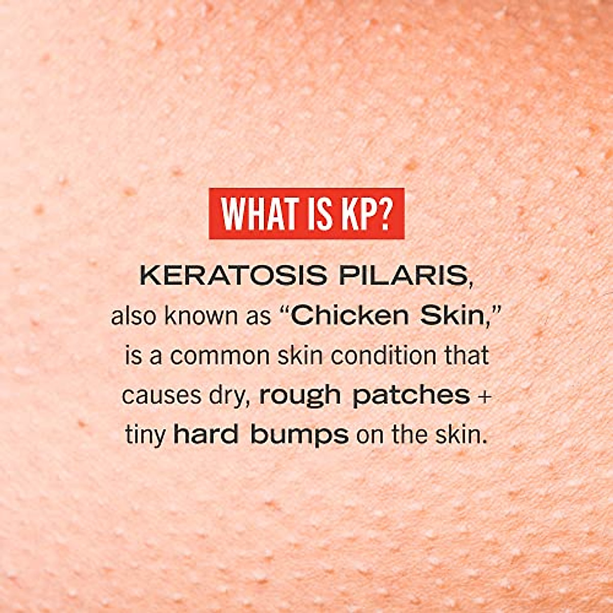 First Aid Beauty KP Bump Eraser Body Scrub Exfoliant for Keratosis Pilaris with 10% AHA – 8 oz