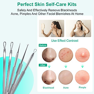 Blackhead Remover Tool,lalasis 5 Pcs Pimple Popper Tool Kit，Blackhead Extractor Tool for Face Comedone Zit Acne Whitehead Blemish Popping Stainless Steel Extraction Tools Set