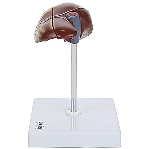 Axis Scientific Anatomy Model of Diseased Liver | Model is 1/3 Life-Size and Divides in 2 Parts | Shows 6 Liver Diseases and Abnormalities | Comes on a White Base