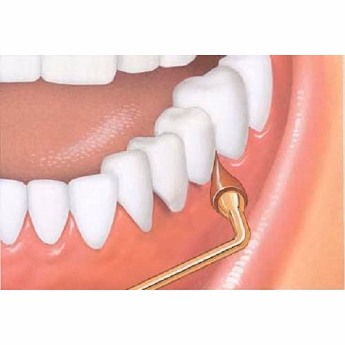 GUM Stimulator 1 Each (Pack of 4)