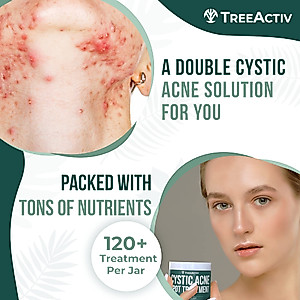 TreeActiv Cystic Acne Spot Treatment, 2-Pack, Sulfur Spot Treatment, Hormonal Acne Treatment with Tea Tree, Cystic Acne, Blackheads, Cystic Acne Treatment and Pimple Spot Treatment for Face, 240+ Uses