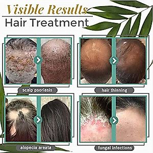 CPO Fᴏlliᴄle Nᴏᴜrishing HairGrᴏᴡth Serᴜm, Biotin Hair Growth Serum, Hair Growth Oil, Hair Regrowth Essence for Women Men, Natural Hair Growth Serᴜm for Hair Loss and Dry Damaged