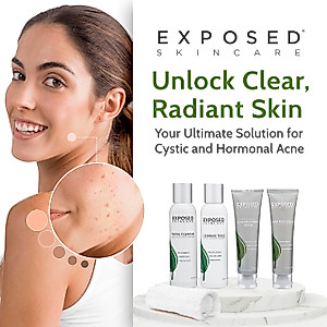 Exposed Skin Care Basic Acne Treatment Kit - Includes Salicylic Acid Face Wash, Clearing Tonic, Acne Treatment Serum with Benzoyl Peroxide, Clear Pore Serum - Acne Set Solution for All Skin Types