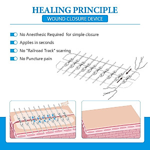 Large Butterfly Bandaids, Steri Strips Wound Closure, Emergency Wound Closure Device Surgical Laceration Repair without Stitches for Extra Large Wound Care, Ahead Be Prepared (PU)