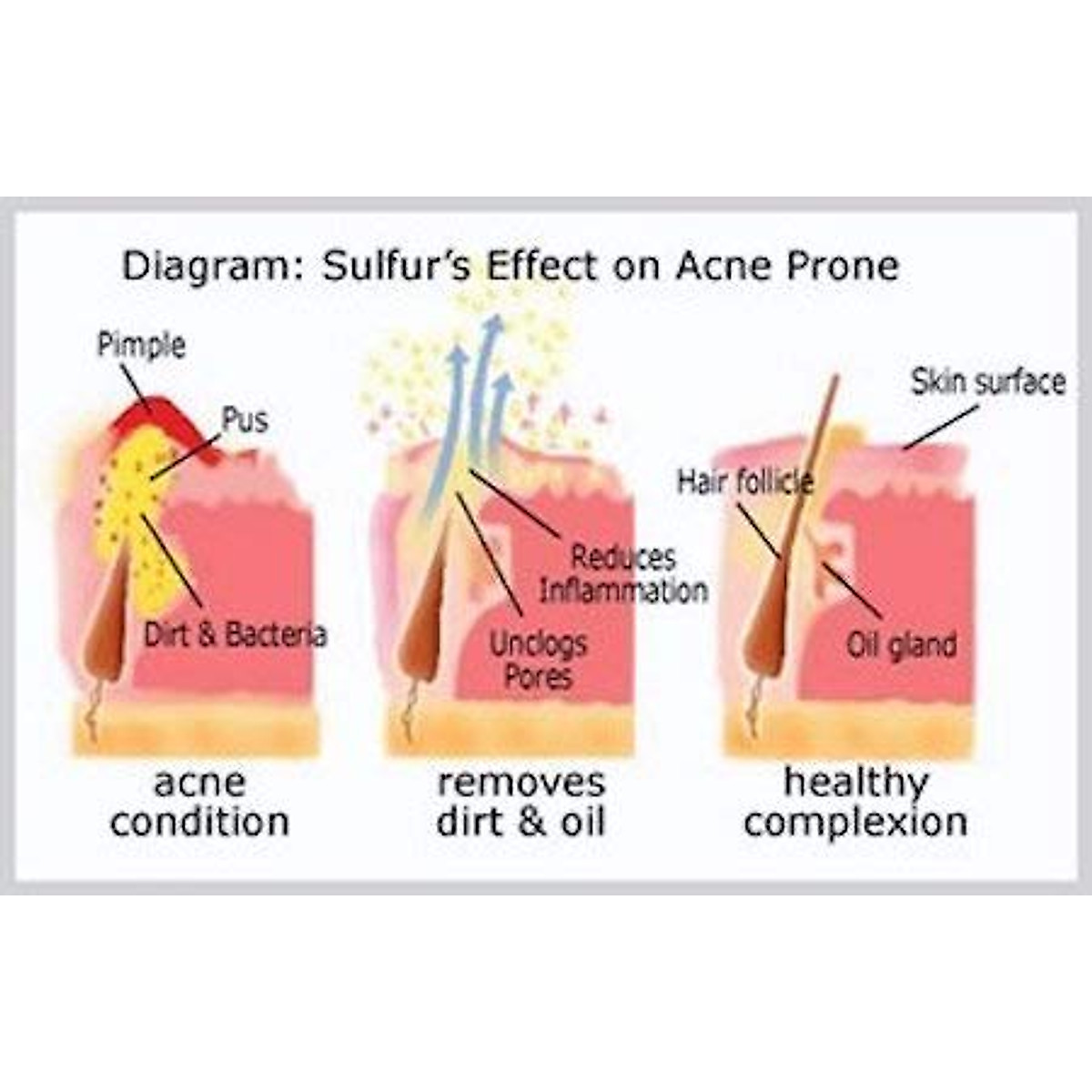 JOESOEF SKIN CARE Sulfur Soap for Acne Pharmaceutical Grade Dermatologists Approved for Acne Rosacea 100G