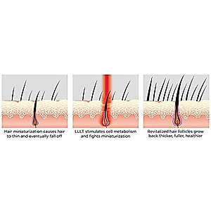 iRestore Essential Laser Hair Growth System - FDA Cleared Hair Loss Treatments for Men & Women & Hair Growth Products for Men with Thinning Hair, Hair Regrowth Treatments Laser Cap, Red Light Therapy