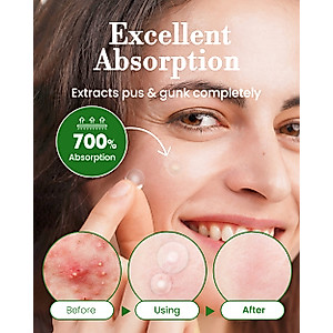 Troubless Invisible Pimple Spot Patch - 96 Ultra Thin Acne Patches - Easy Peel - 2 Sizes