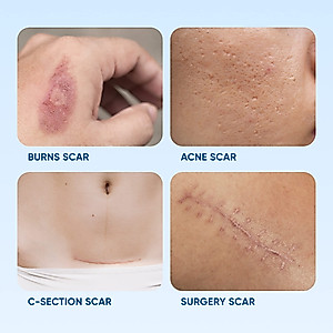 Silicone Scar Removal Sheets - Breathable Reusable & Waterproof Keloid Scar Removal Patches Caused by C-Section, Surgery, Burn, Acne, Stretch Marks Healing Alternative to Gel, Tape & Cream (4 sheets)