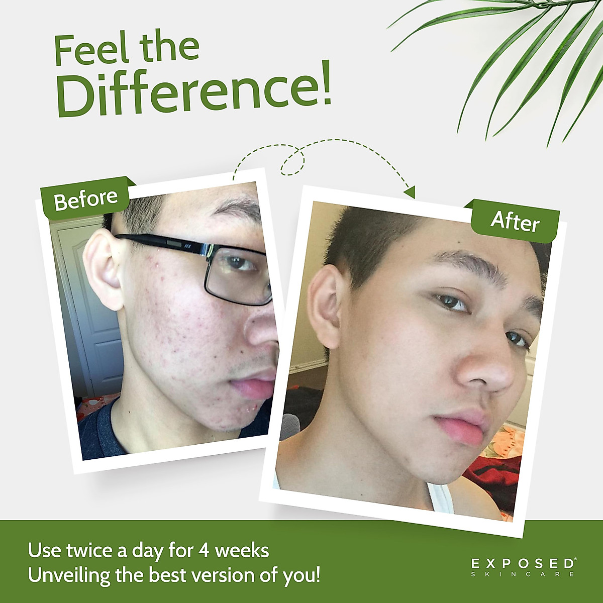 Exposed Skin Care Acne Treatment Kit - Includes Facial Cleanser, Clearing Tonic, Acne Treatment Serum, Clear Pore Serum, Clarifying Mask, Cloth - Natural Acne Solution for Face, All Ages & Skin Types