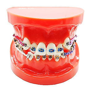 Dental Typodont With Metal Brackets Orthodontic Teeth Model With Ligature Ties Red