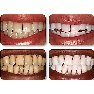 Ultra White 22% Teeth Whitening Gel Large 5 Tubes 3.8 ml of Gel use for Beautiful White Smile